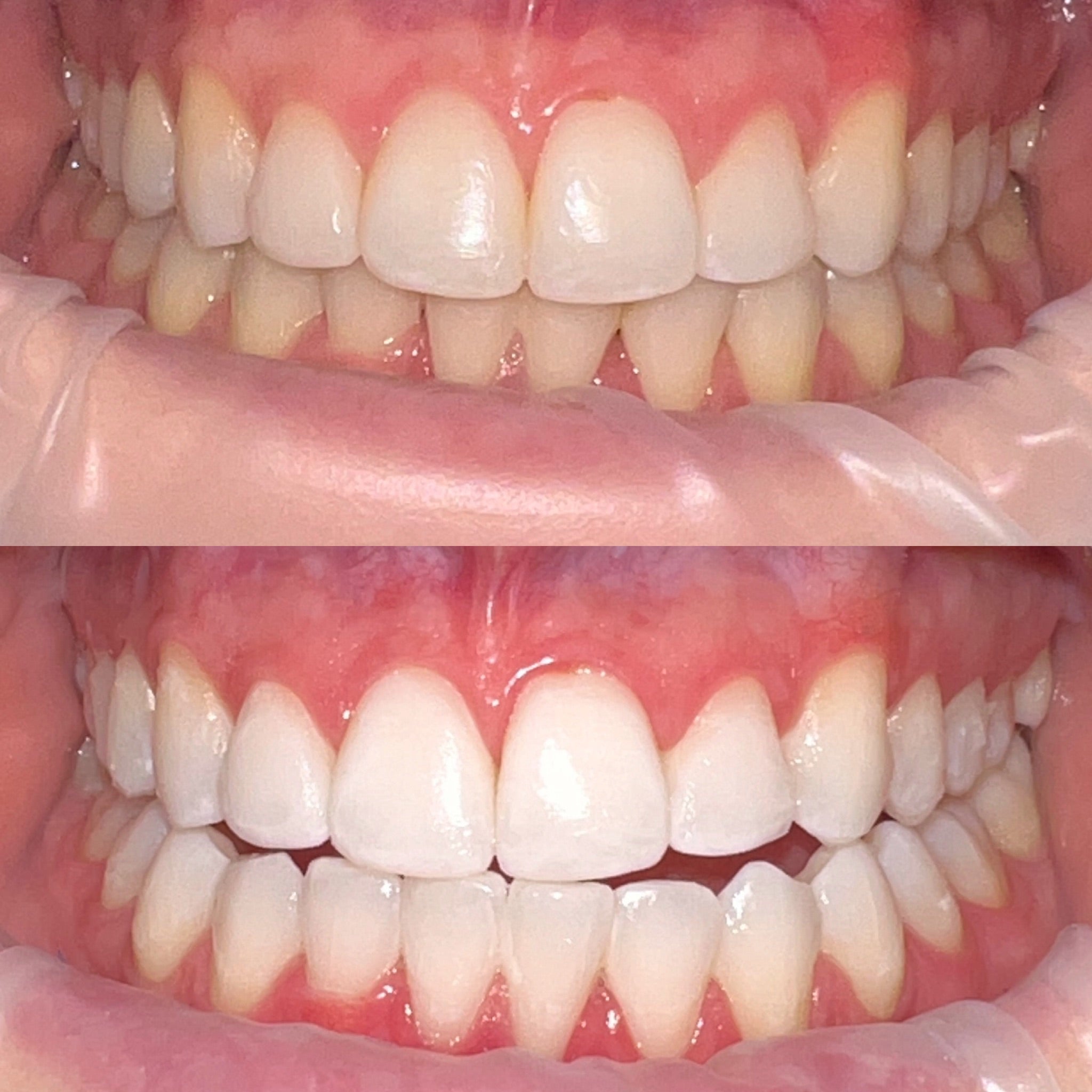 Results – Essential Whitening